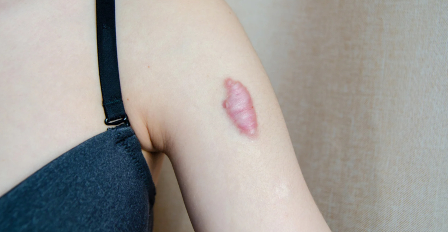 Keloid Scars: How to Best Prevent and Treat Them