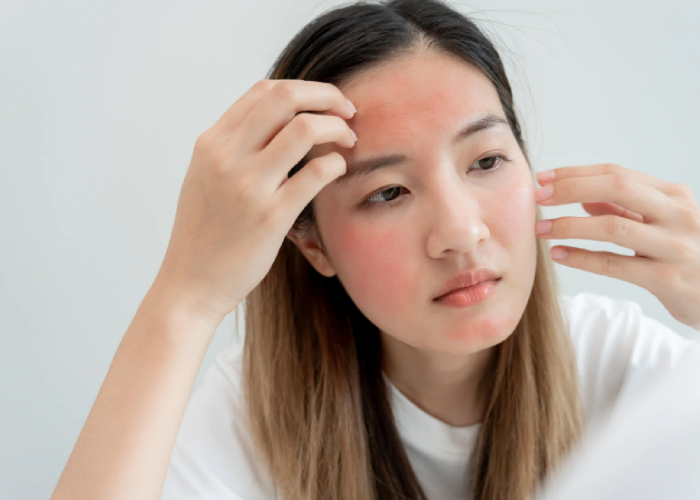 Heat Rash: How to Treat It Quickly in Singapore’s Climate