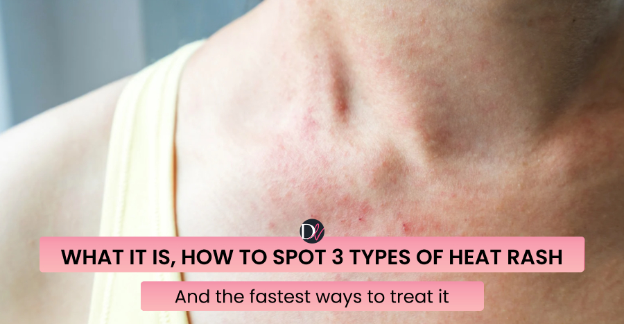 Heat Rash: How to Treat It Quickly in Singapore’s Climate