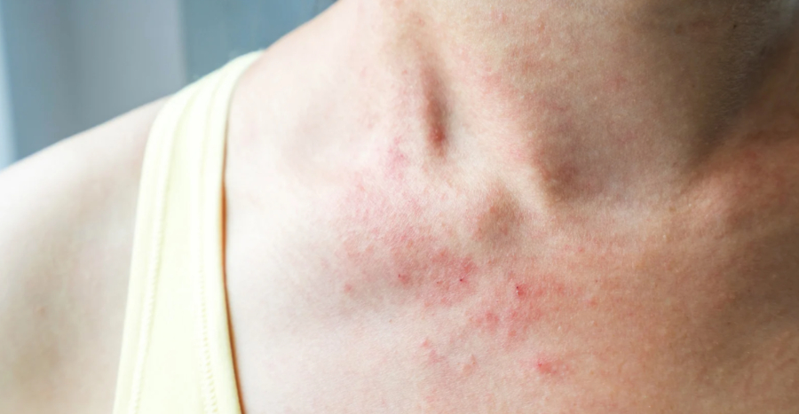 Heat Rash: How to Treat It Quickly in Singapore’s Climate